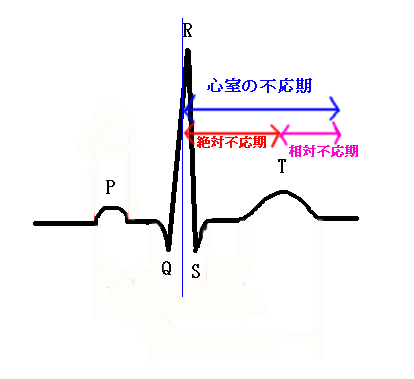 非伝導性上室性期外収縮(blocked PAC)の心電図とは | 看護師学習ノート