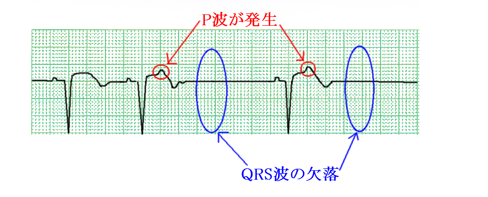 非伝導性上室性期外収縮(blocked PAC)の心電図とは | 看護師学習ノート